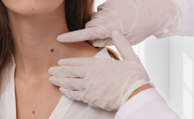 Skin Tag: Gejala, Penyebab, Diagnosis, Pengobatan