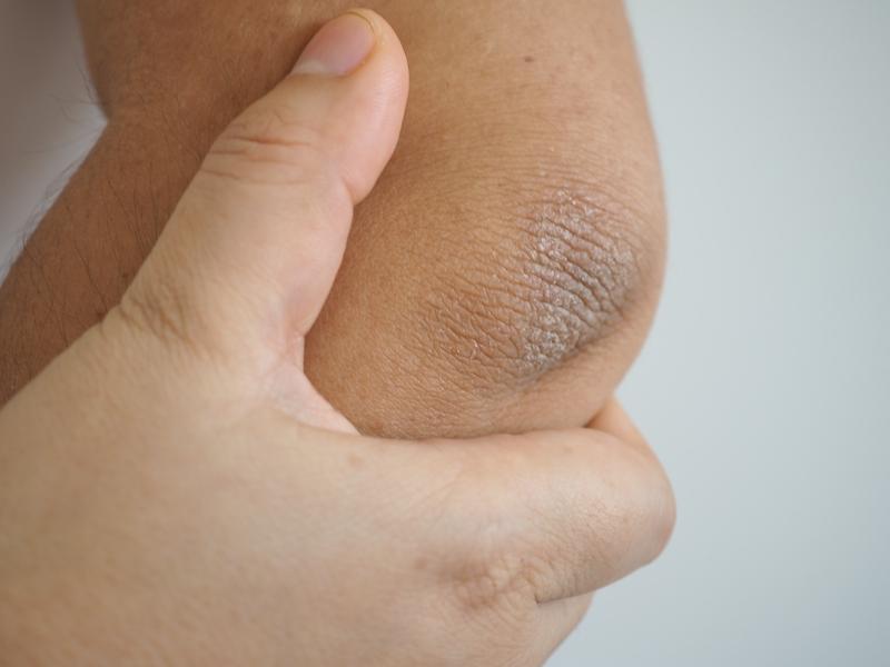 7 Cara Mudah Menghilangkan Siku Hitam - Hello Sehat