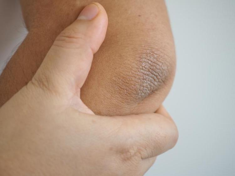 7 Cara Mudah Menghilangkan Siku Hitam - Hello Sehat