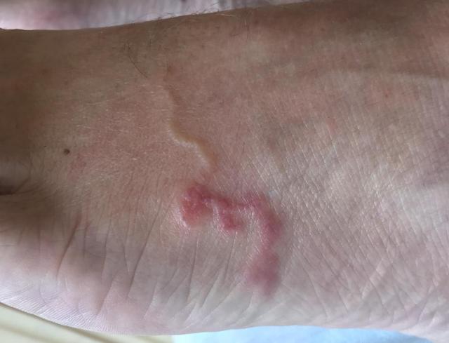 Cutaneous Larva Migrans: Gejala, Penyebab, Obat - Hello Sehat