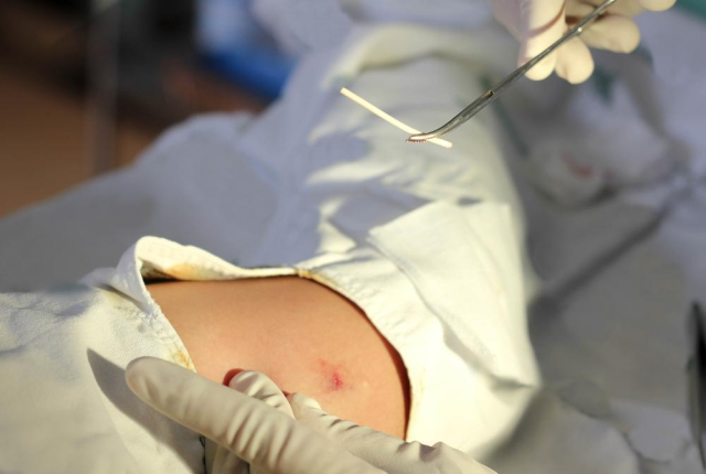 Efek Samping KB Implan pada Siklus Haid, Apakah Bahaya? - Hello Sehat