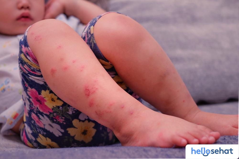 Artikel Kesehatan Infeksi Virus | Hello Sehat