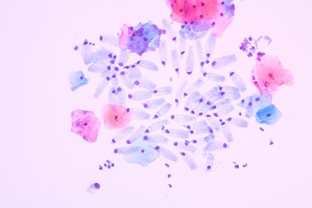 Tipe HPV, dari yang Tak Berbahaya hingga Penyebab Kanker Serviks