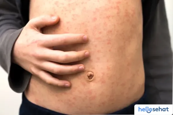 Gatal di Perut Bintik Merah, Ini 7 Penyebab dan Pengobatannya