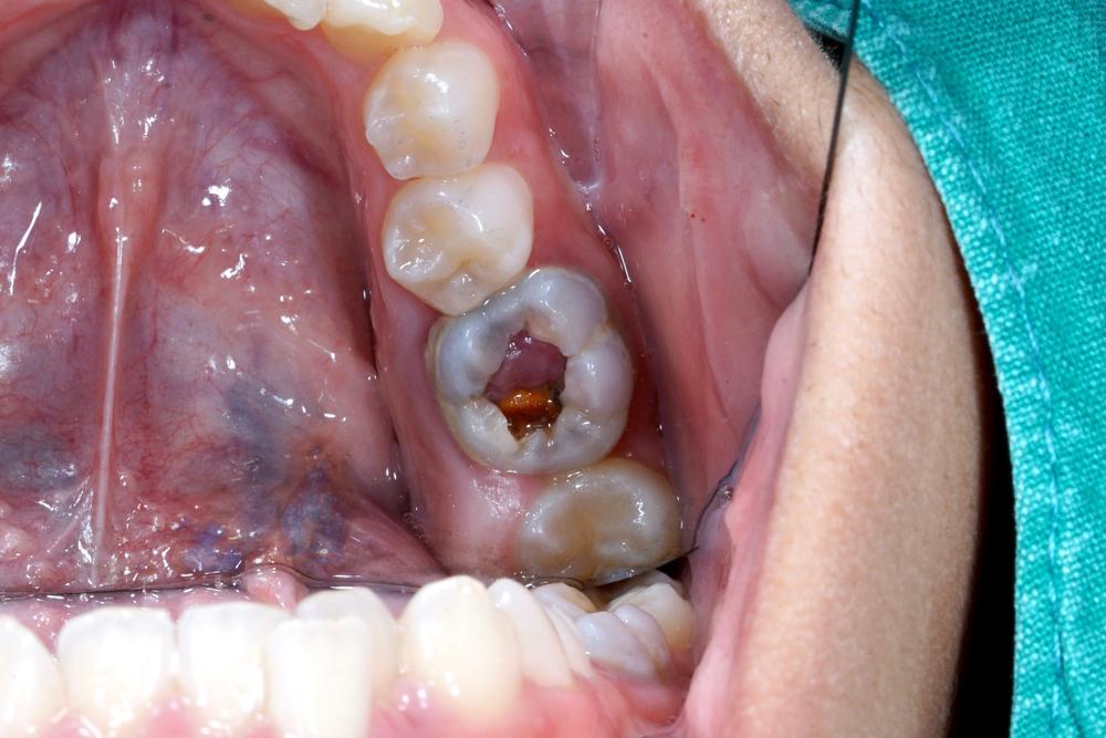 Polip Pulpa: Gejala, Penyebab, Pengobatan, dll. - Hello Sehat