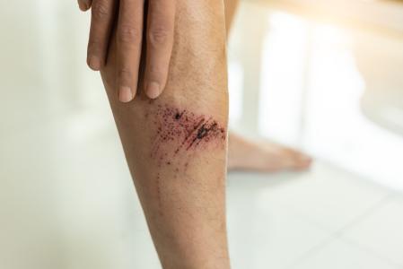 Koreng Bernanah, Ketika Luka Terinfeksi oleh Kuman