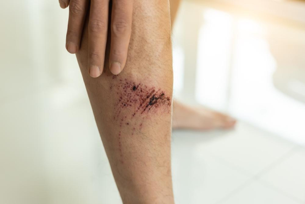 Koreng Bernanah, Begini 7 Cara Mengatasinya - Hello Sehat