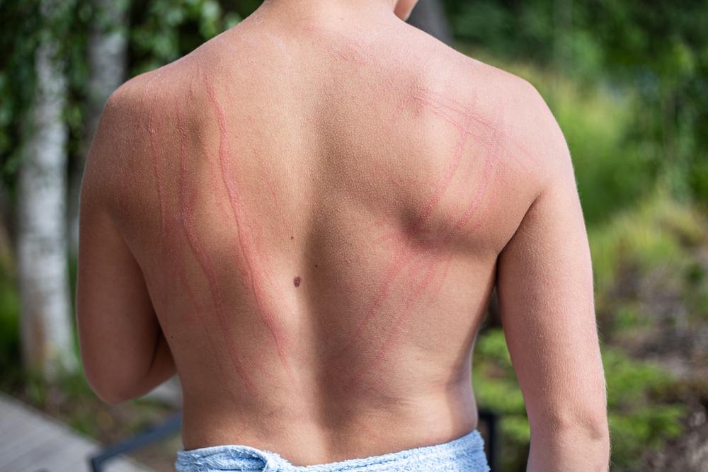 Dermatographia: Gejala, Penyebab, dan Pengobatan