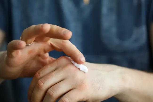 Desoximetasone: Kegunaan, Dosis, Efek Samping - Hello Sehat