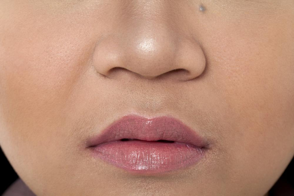 Fungsi Filtrum Lekukan di Atas Bibir dan Bentuk Kelainannya