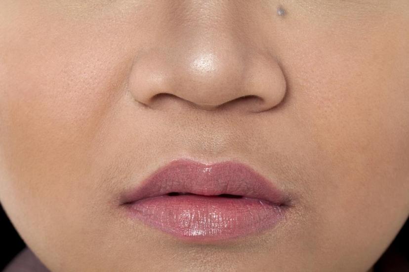 Fungsi Filtrum Lekukan di Atas Bibir dan Bentuk Kelainannya