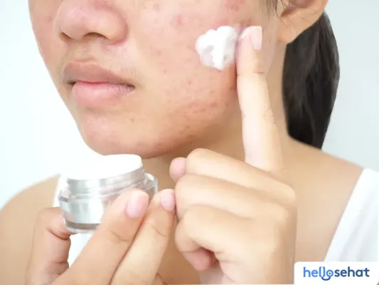 10 Sunscreen untuk Kulit Berjerawat Terbaik dan Patut Dicoba