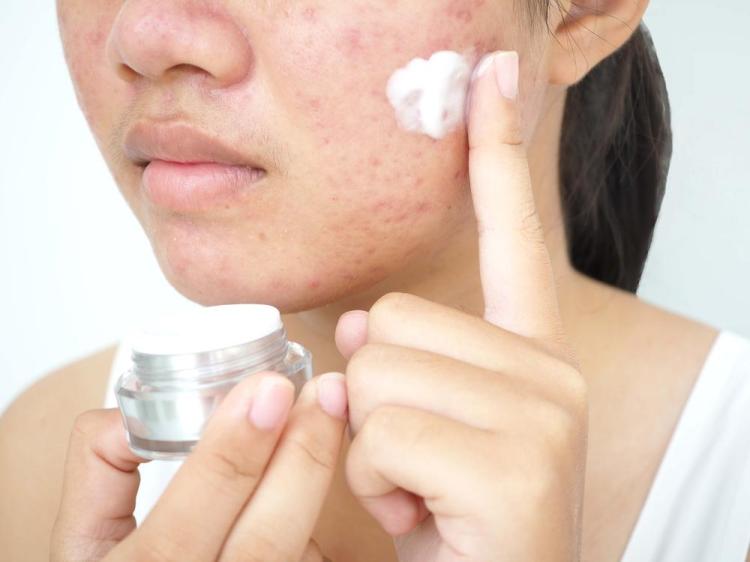 10 Sunscreen Untuk Kulit Berjerawat Terbaik Dan Patut Dicoba