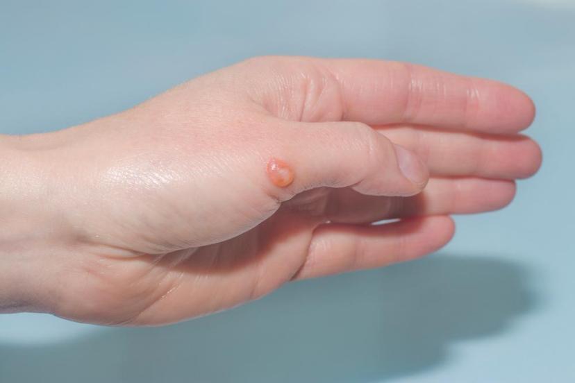 Lenting: Gejala, Penyebab, Pengobatan - Hello Sehat