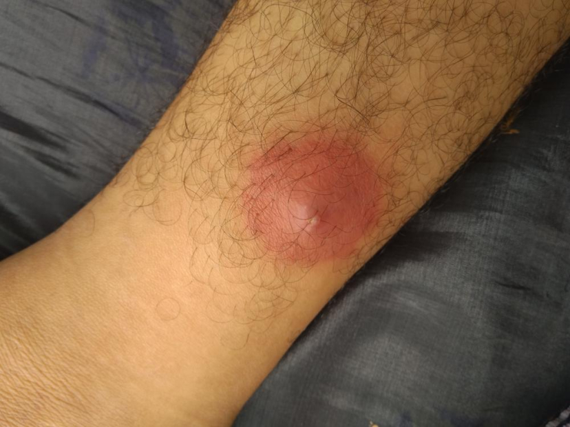 Phlegmon: Gejala, Penyebab, dan Pengobatan - Hello Sehat