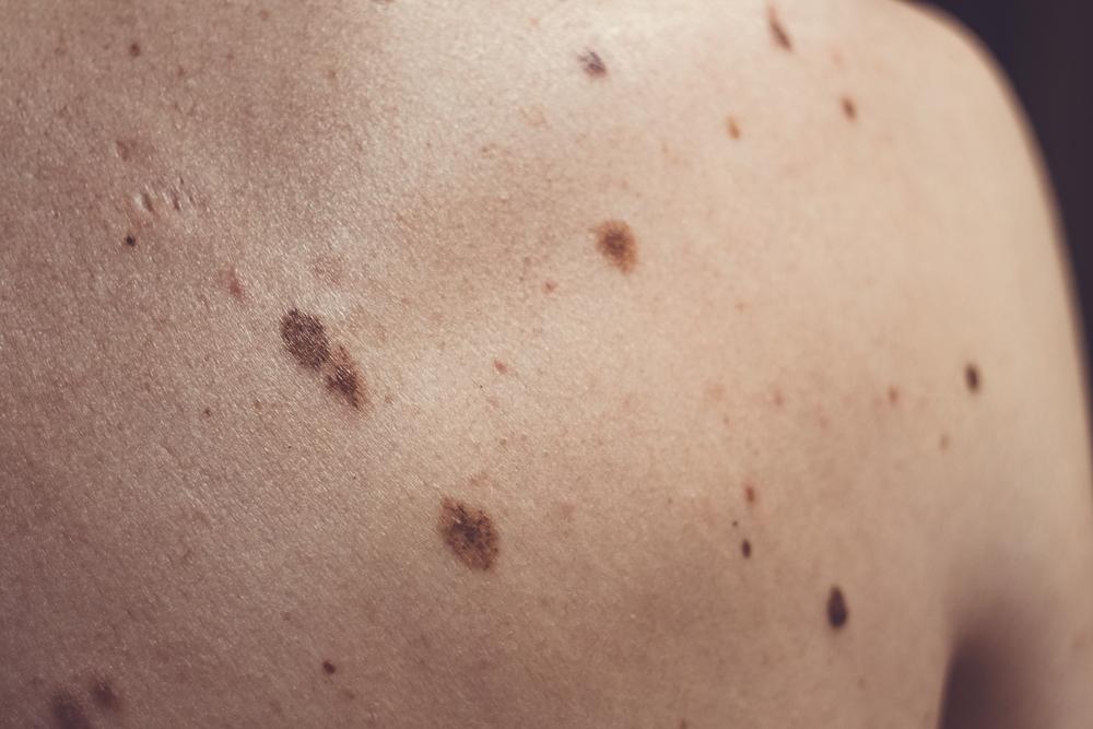 Nevus: Gejala, Penyebab, dan Pengobatannya - Hello Sehat