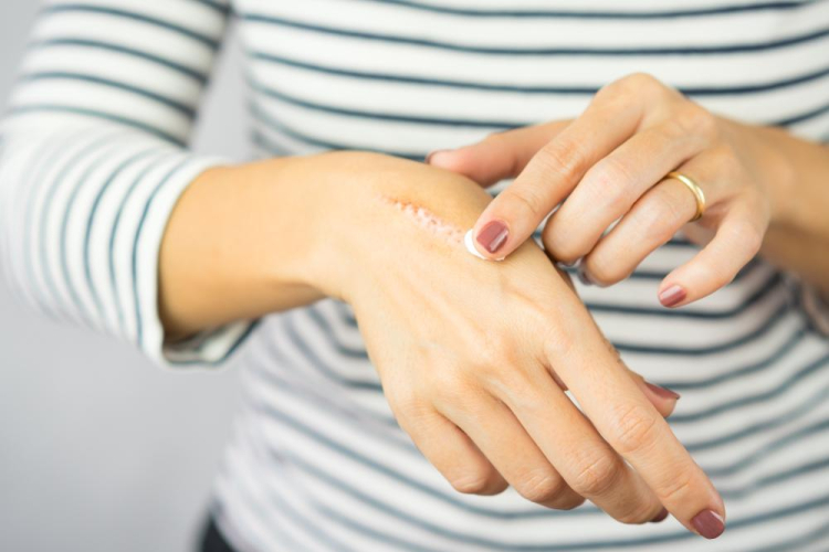 Dermatix Wound Care: Manfaat, Cara Pakai, dan Dosis - Hello Sehat