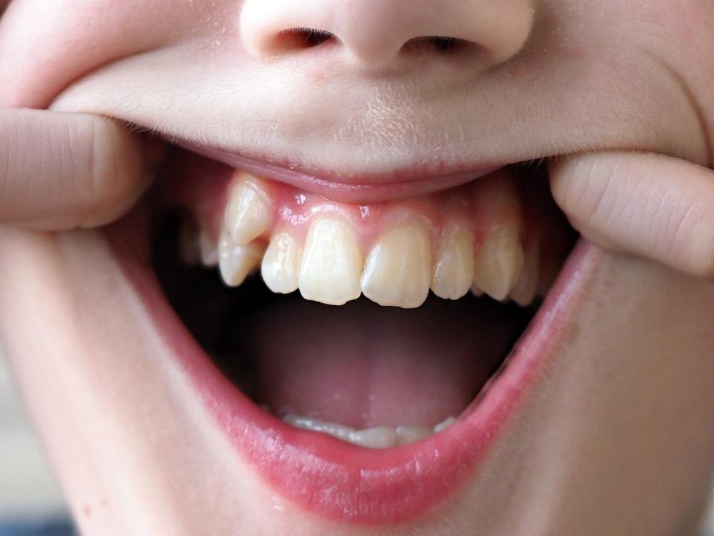 Penyebab Gigi Bertumpuk pada Anak dan Cara Mengatasinya