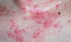 Eksim (Dermatitis Atopik): Gejala, Penyebab, dan Pengobatan