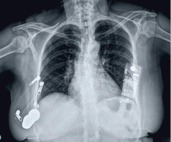 Cara Mengatasi Corpus Alienum, Benda Asing di dalam Tubuh