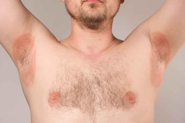 Intertrigo, Kenali Gejala, Penyebab, dan Cara Mengobati