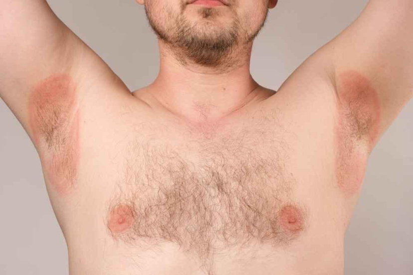 Intertrigo, Kenali Gejala, Penyebab, dan Cara Mengobati