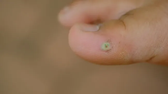 Penyakit Jiggers: Gejala, Penyebab, dan Pengobatan