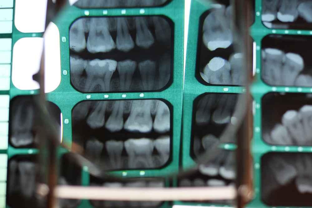 Rontgen Periapikal: Definisi, Tujuan, dan Prosedur