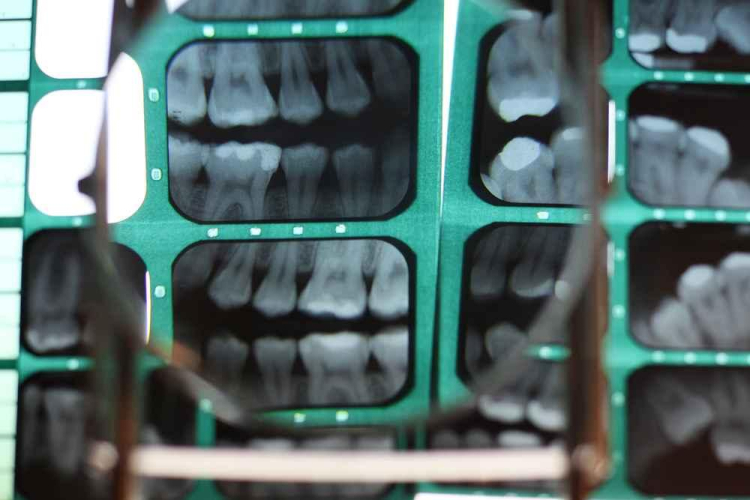 Rontgen Periapikal: Definisi, Tujuan, dan Prosedur