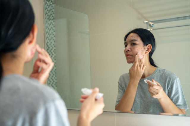 8 Cara Menghilangkan Jerawat Batu yang Sulit Sembuh