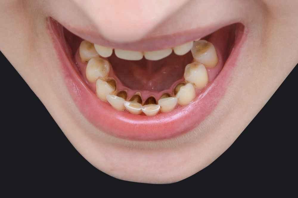 5 Penyebab Karang Gigi Hitam dan Cara Menghilangkannya - Hello Sehat