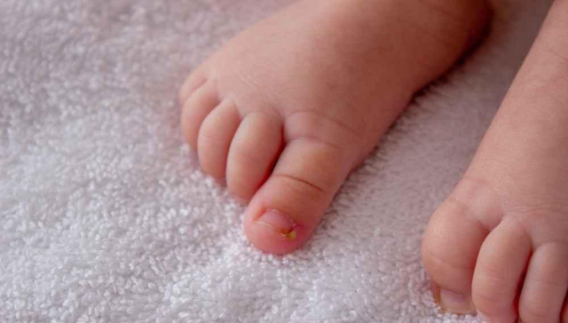 4 Cara Mengatasi Cantengan pada Bayi serta Pencegahannya