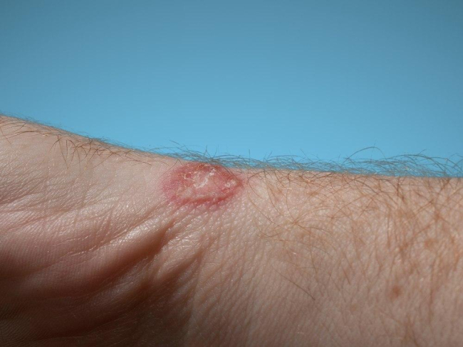 Tinea Manus: Gejala, Penyebab, Pengobatan, dan Pencegahan