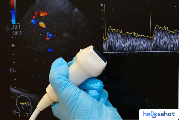 Transcranial Doppler: Definisi, Prosedur, dan Efek Samping