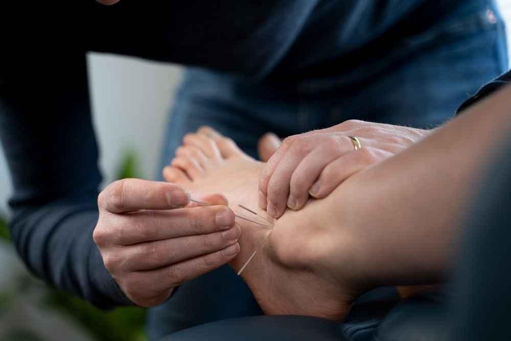 Dry Needling: Manfaat, Prosedur, dan Efek Samping