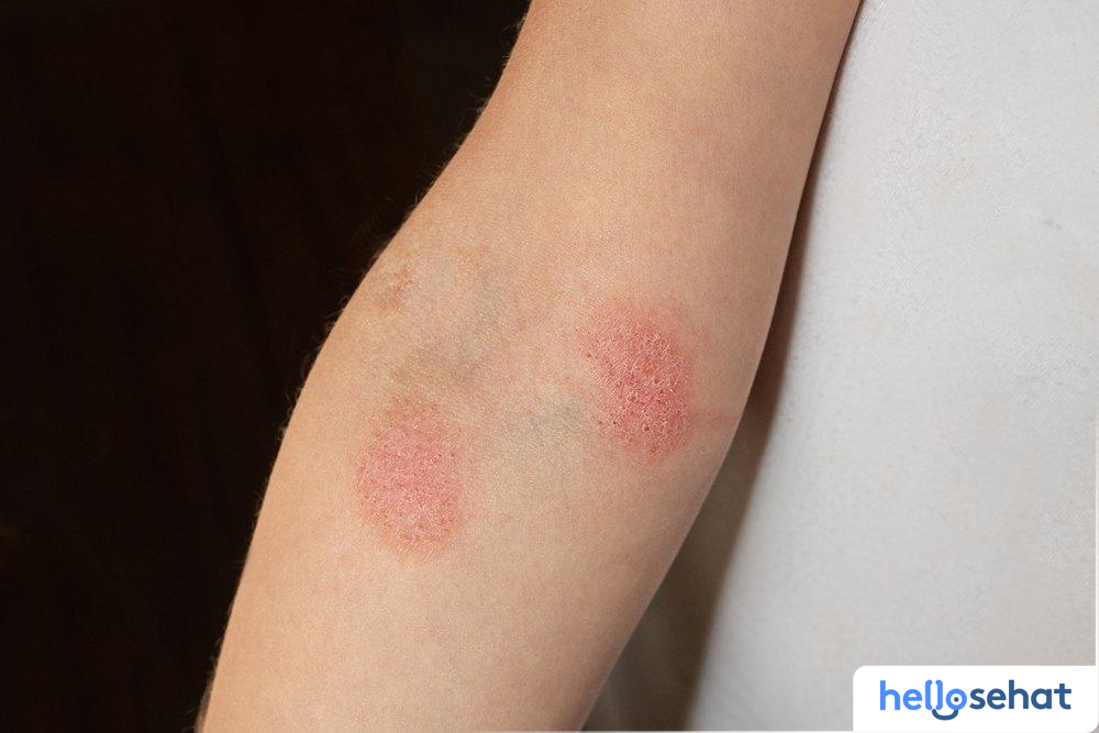 Artikel Kesehatan Seputar Penyakit Infeksi Kulit | Hello Sehat