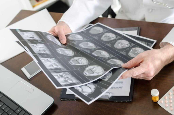 Stroke Ringan: Gejala, Penyebab, hingga Pengobatan | Hello Sehat